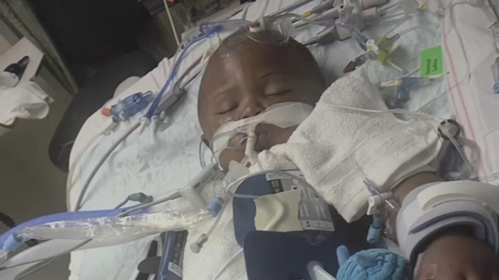 1-year-old Legend Smalls had part of his skull removed, remains in ICU ...