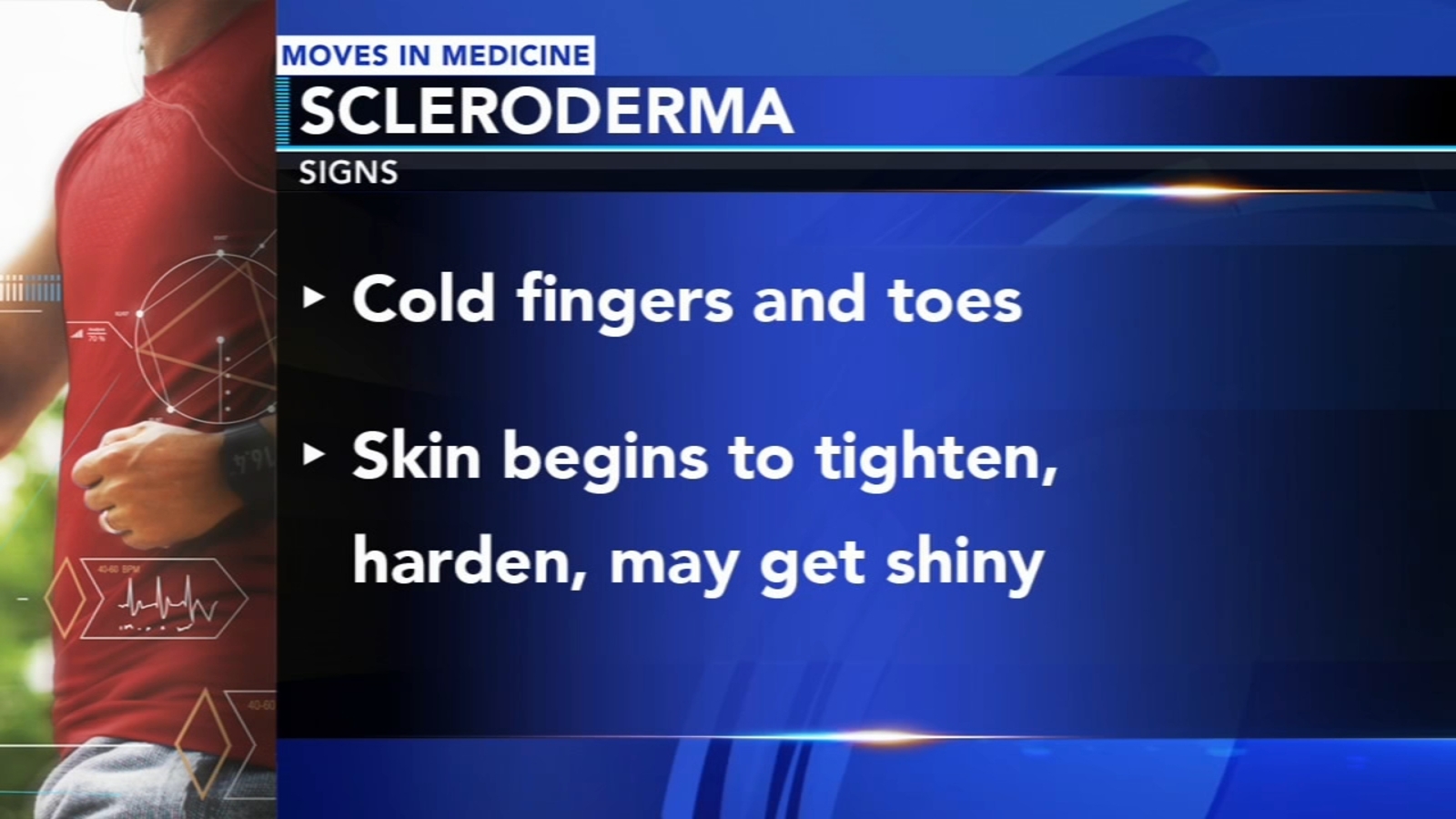 What is Scleroderma? Temple Health outlines diagnosis, treatment of ...