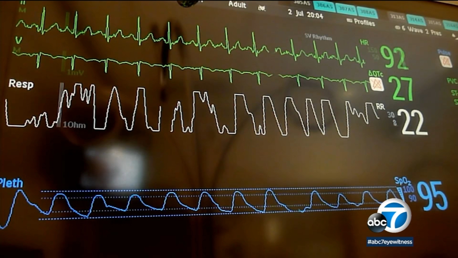 COVID-19: Unexpected long-term heart symptoms occur in up to 1/3 of ...
