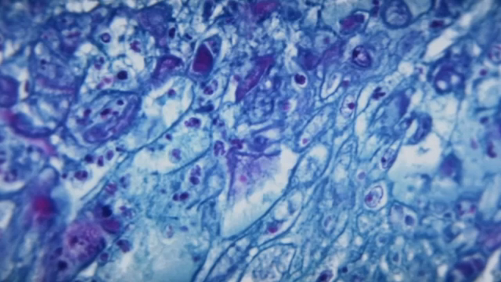 'It's been a journey': Man with first Monkeypox case in Durham County ...