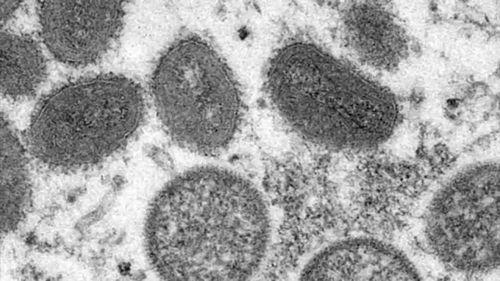 Monkeypox Chicago: City health officials emphasize testing, prevention ...