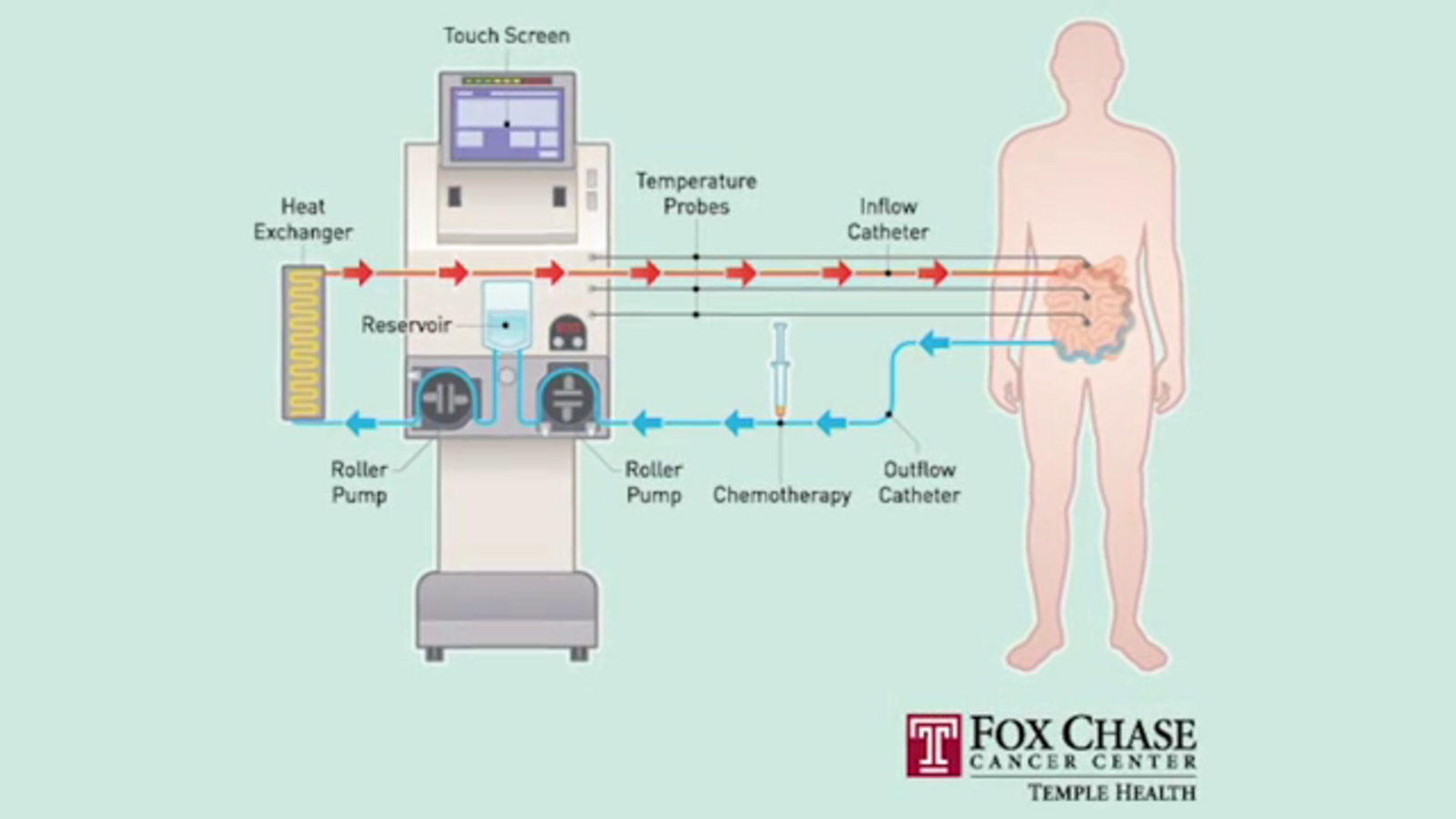 Hyperthermic Intraperitoneal Chemotherapy offers a boost against ...