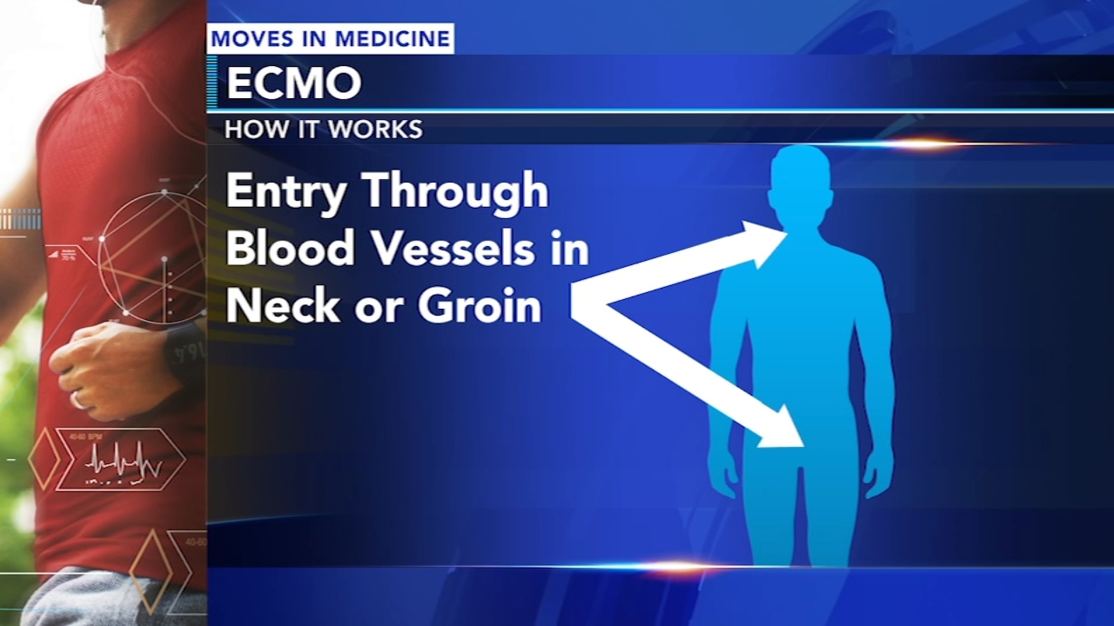 Taking a closer look at Extra-Corporeal Membrane Oxygenation (ECMO ...