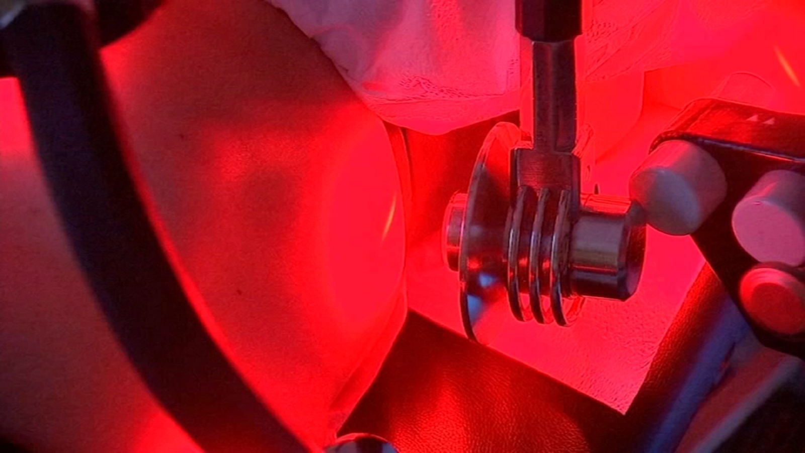 Local Spotlight featuring Innovative Lasers. Lose weight with the ...