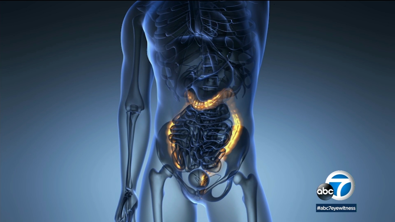 Colon Cancer
