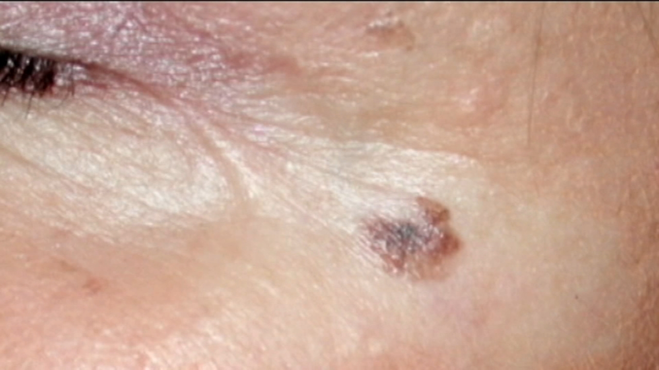 Early Stage Melanoma Pictures