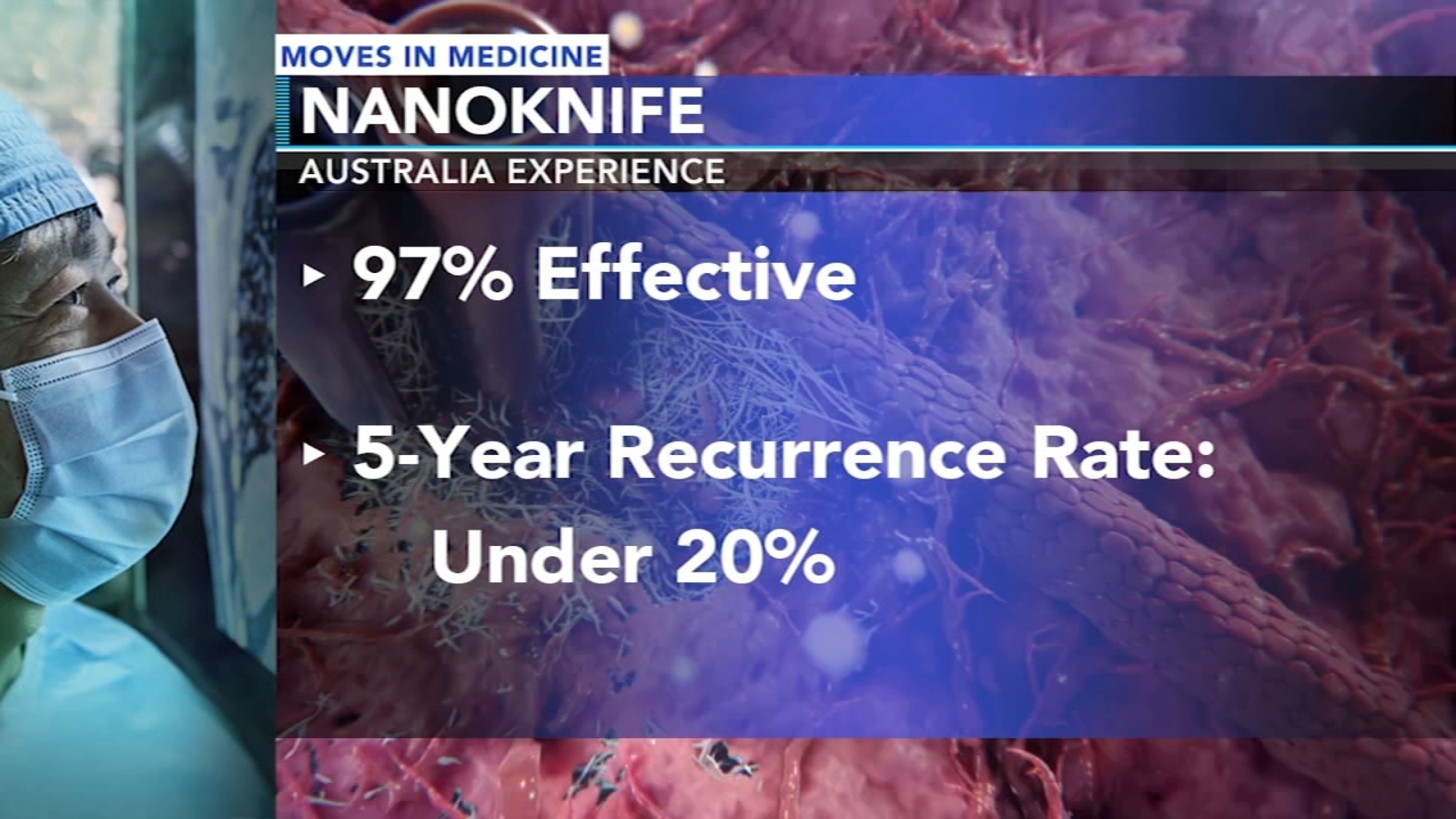 At Fox Chase Cancer Center aims to destroy tumors with NanoKnife ...