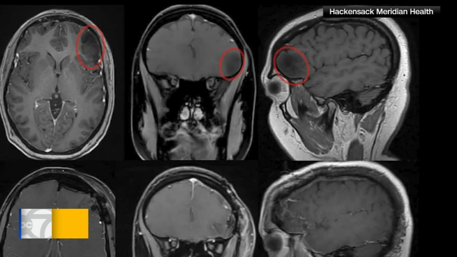 Patient sings 'Moana' soundtrack during brain tumor removal - ABC30 Fresno