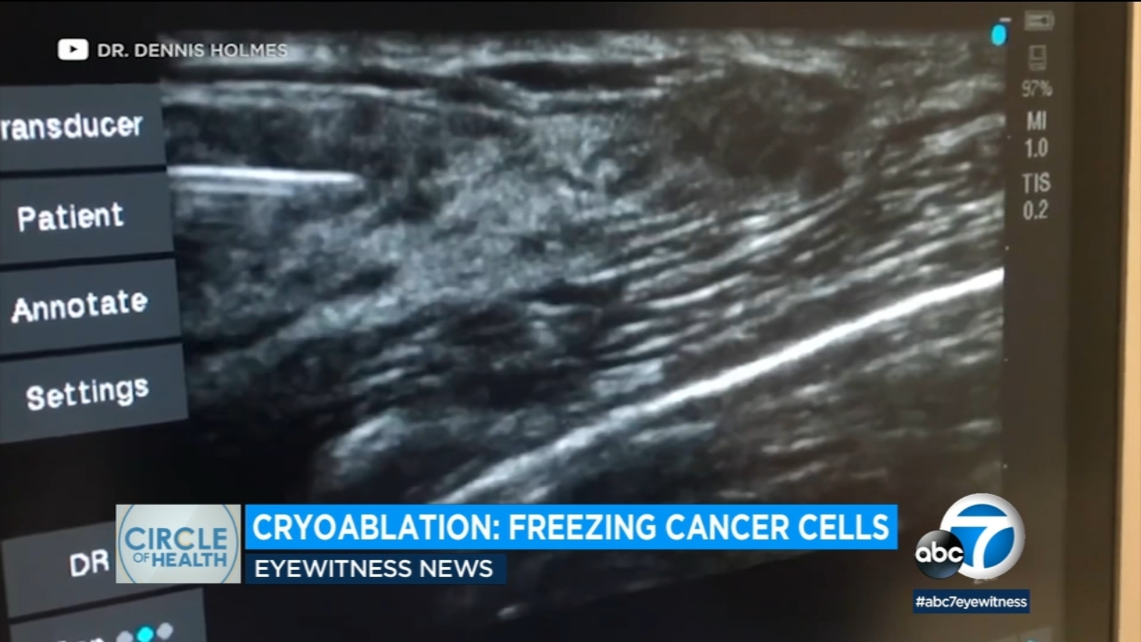 Freezing away earlier stages of breast cancer? How Cryoablation could ...