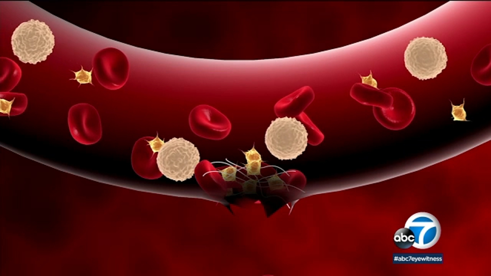 Coronary calcium score can provide important information on your risk ...