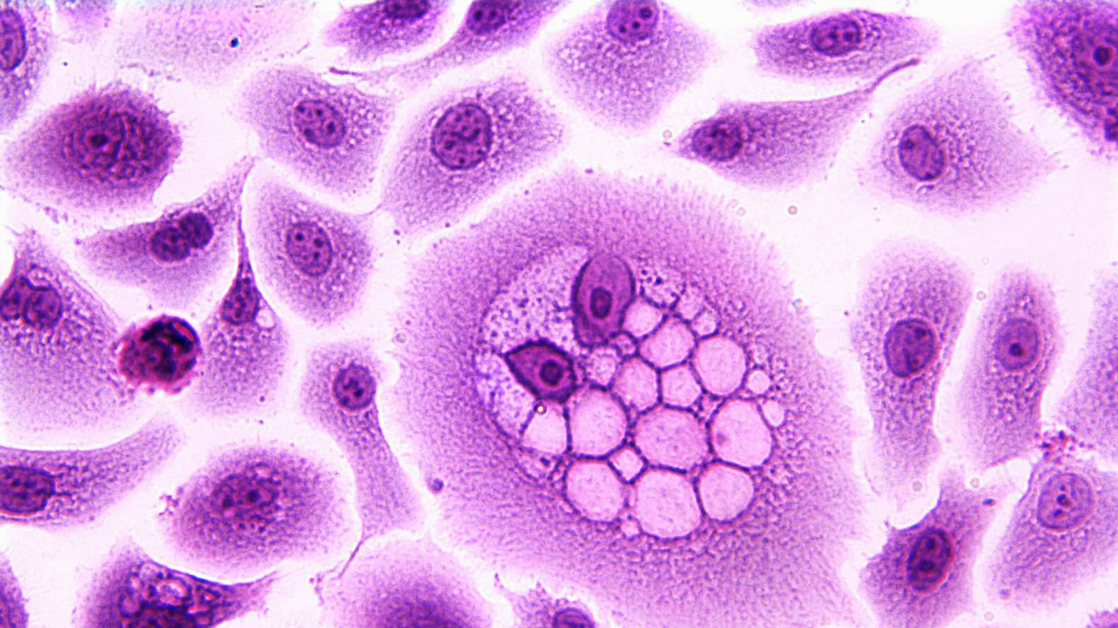 What to know about self-swabbing for HPV after FDA approves new kits ...