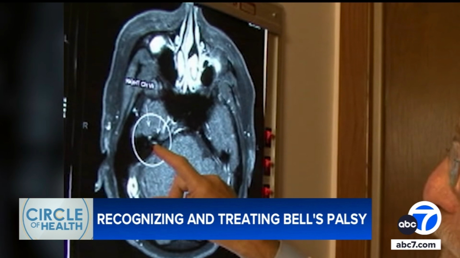 Bell's Palsy: Recognizing symptoms of facial paralysis early is key to ...