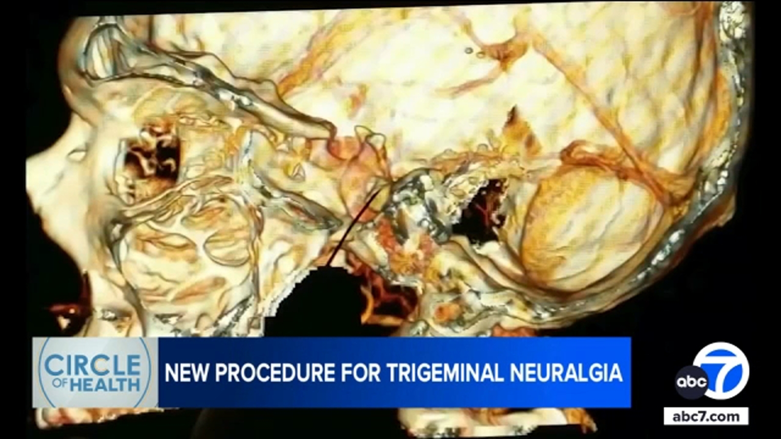 Trigeminal neuralgia pain, symptoms may be permanently relieved by new ...