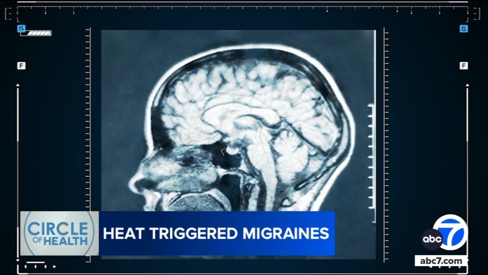 Here's why summer summer heat can trigger migraines; experts offer ...