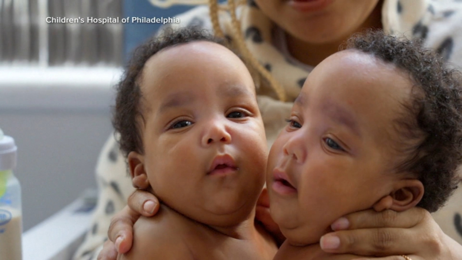 Twin brothers born conjoined celebrate 1st birthday after separation ...