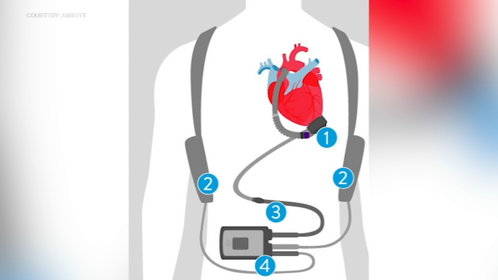 Mechanical help, VAD heart pump keeps Delaware heart failure patient on ...