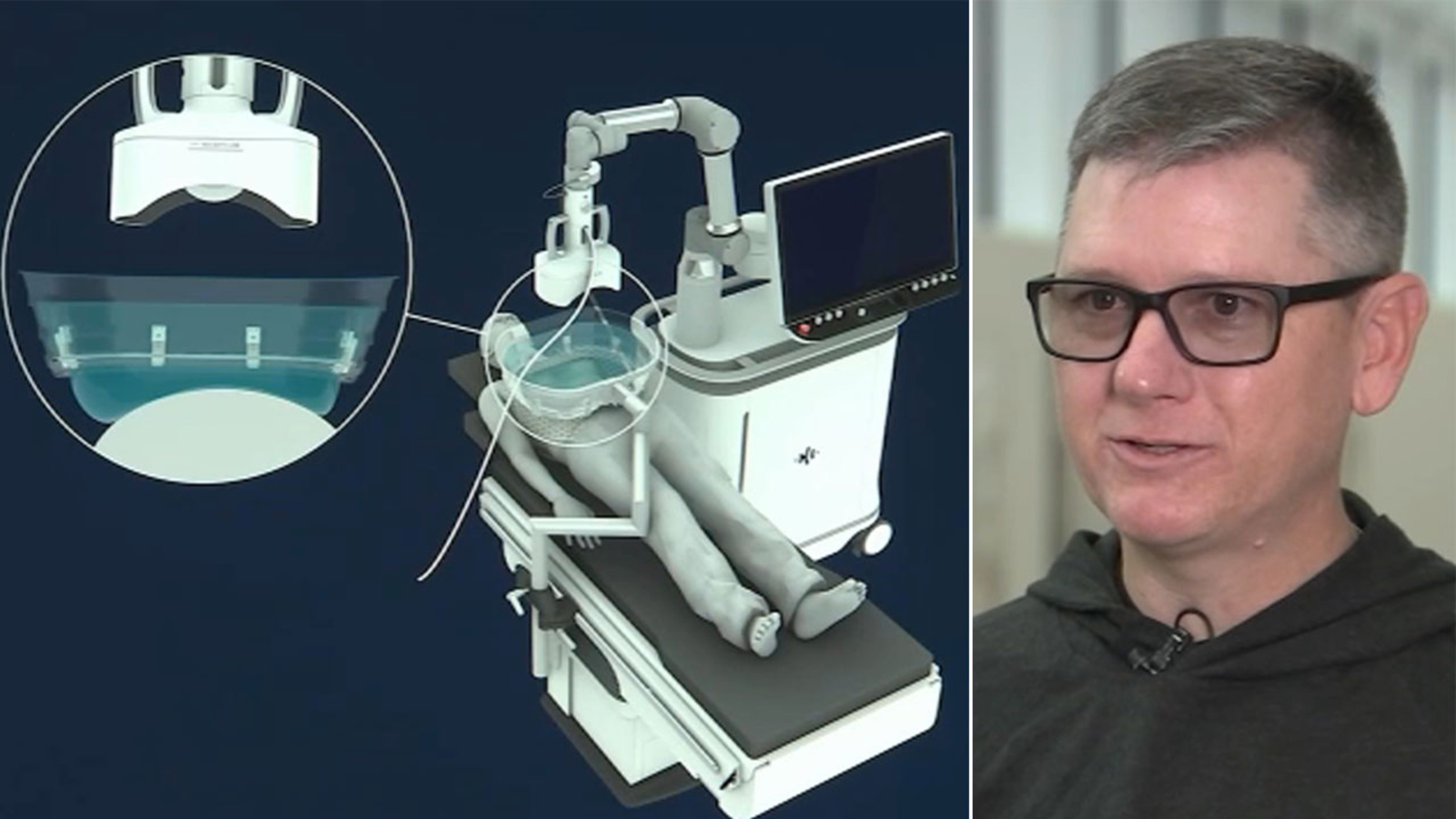 Histotripsy treatment, FDA-approved therapy that kills cancer using ...