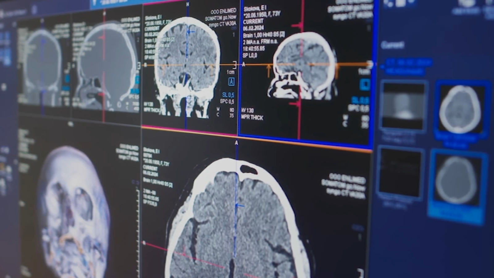 Lowering your risk of ALS and other nervous system diseases - 6abc ...
