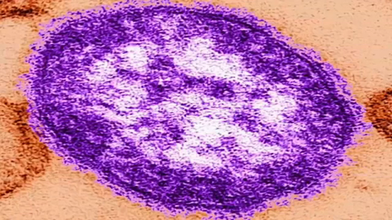 Texas measles outbreak: Harris County reports first cases of measles ...