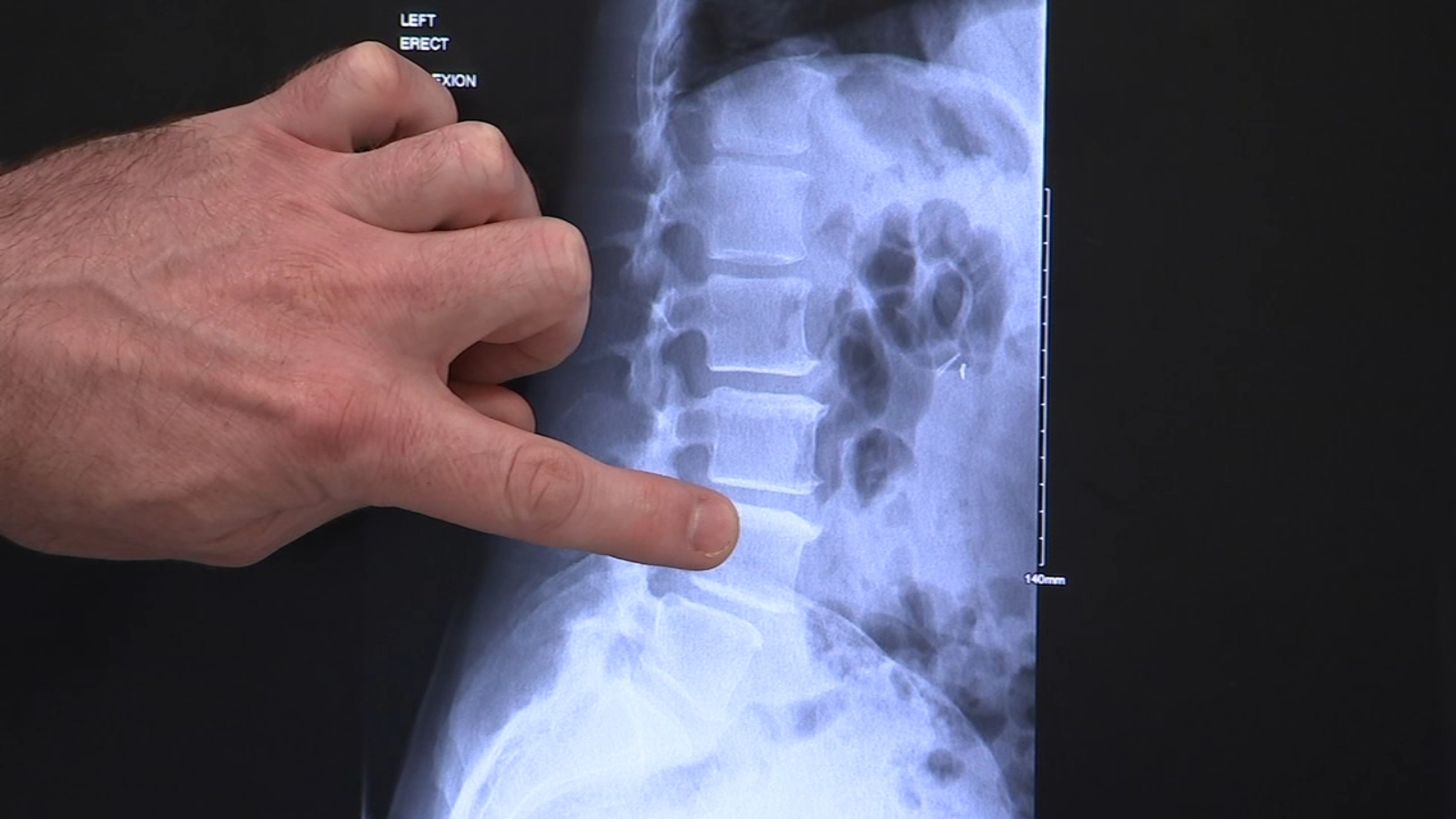 A new approach to spinal fusion for ending some back pain | Well Ahead ...