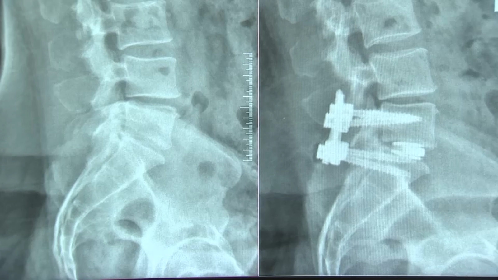 Awake spine surgery credited with short recovery time for patients ...