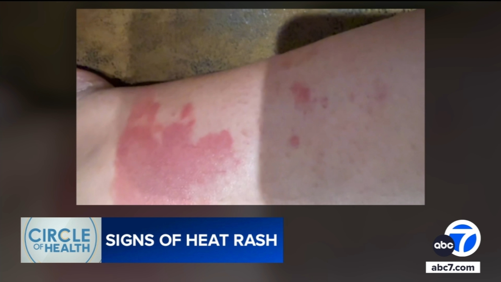 Standing in line at amusement parks or hiking in summer sun? Doctors ...