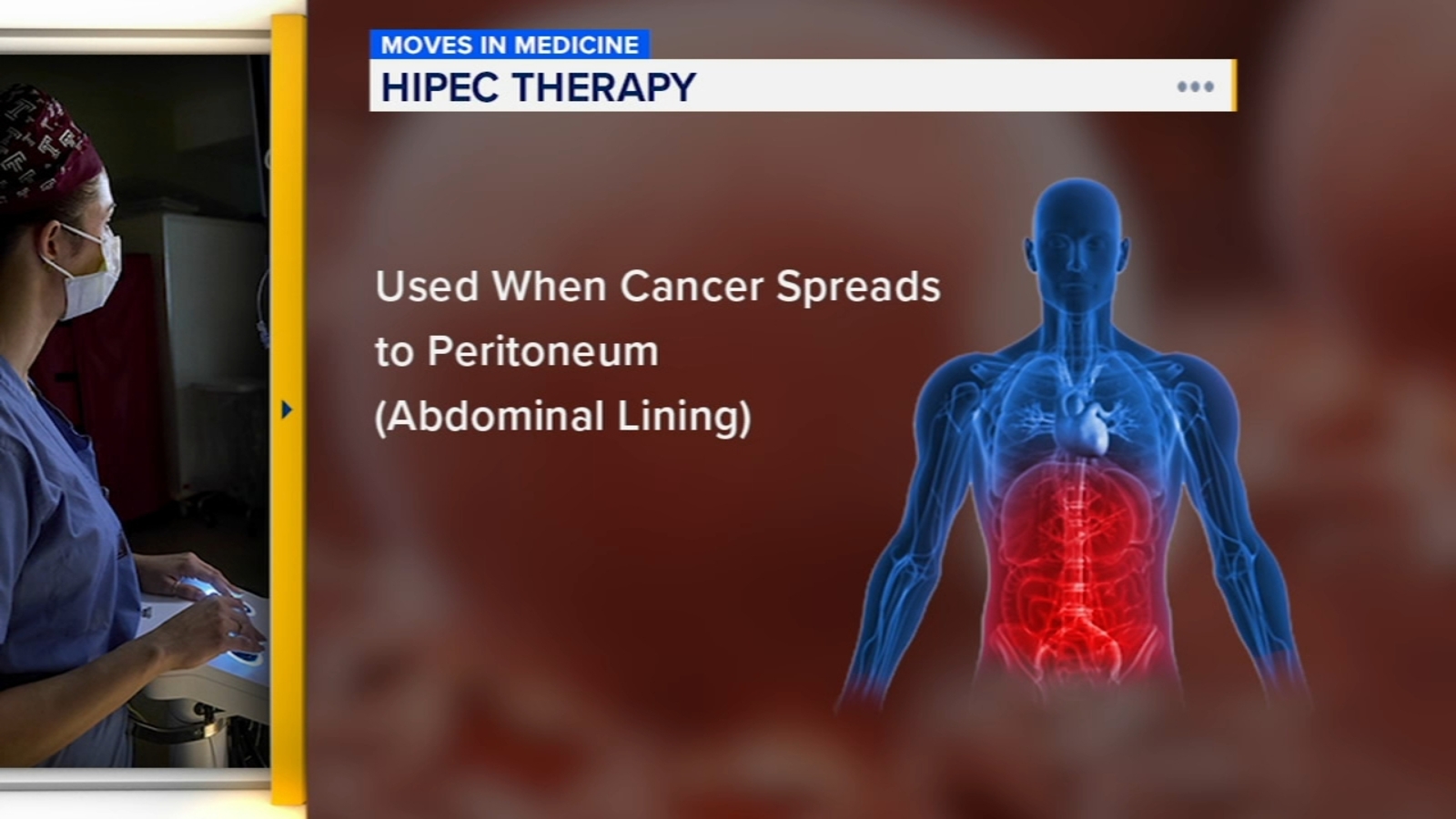 Heated chemotherapy can extend survival when cancer spread to abdomen ...