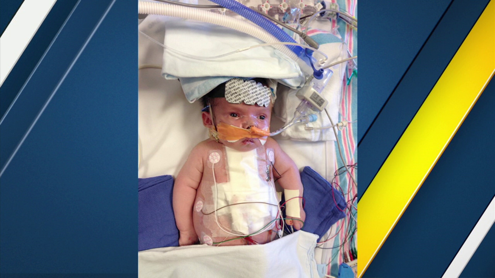 3-D printed heart valve helps doctor practice surgery for baby at ...