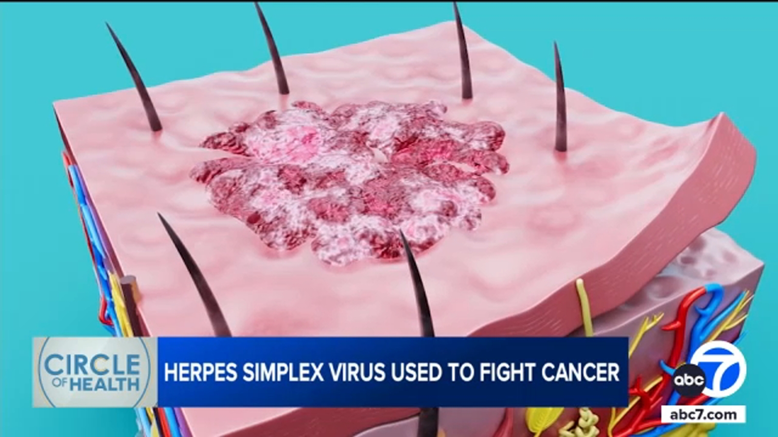 USC researchers turn common herpes virus into cancer fighting tool in ...