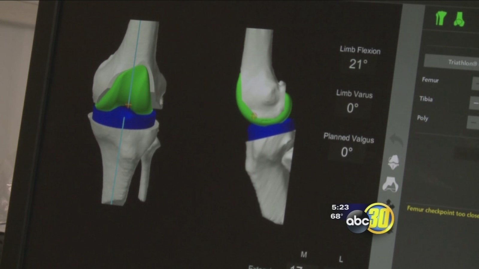 Mako Rio makes knee replacement easier - ABC30 Fresno