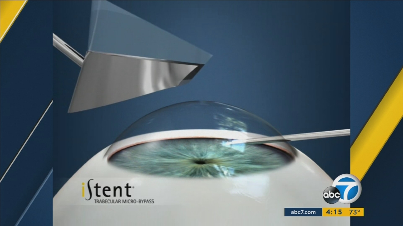 Northridge doctor uses small device to improve vision - ABC7 Los Angeles