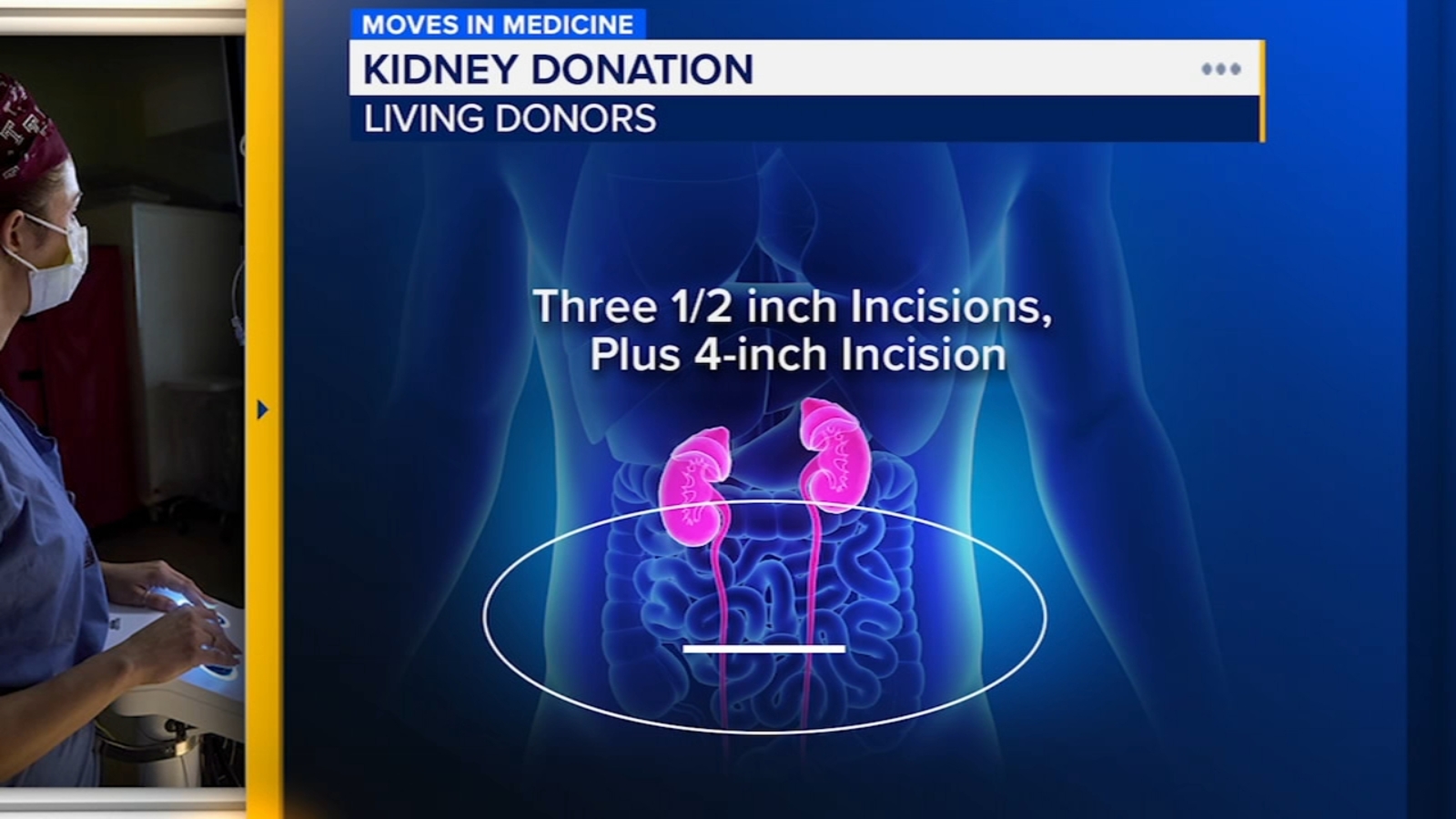 Living kidney donations on the rise | Moves in Medicine - 6abc Philadelphia