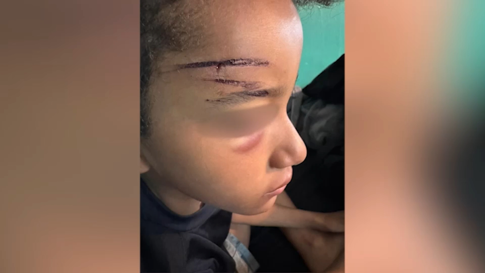 Bronx 9-year-old child punched in face in Grant Park in Claremont; 15 ...