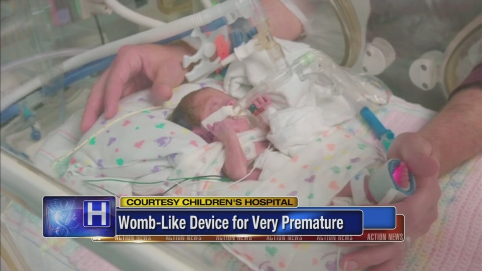 "Artificial womb" could help preemies avoid deaths and disabilities ...