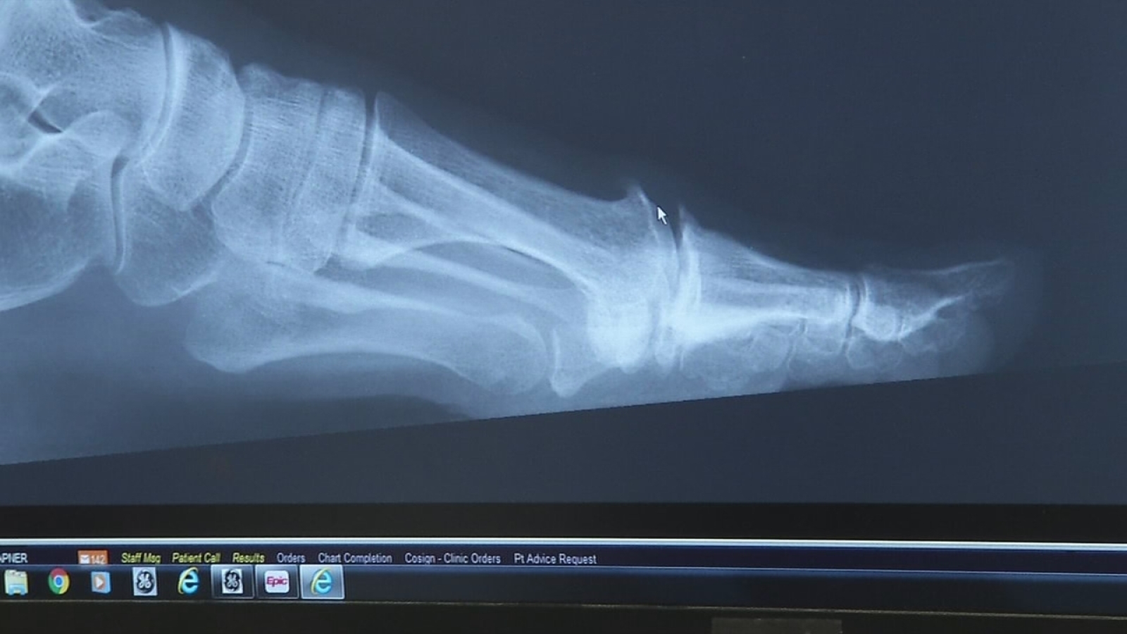 Fixing painful toe joints with Cartiva, first synthetic cartilage ...