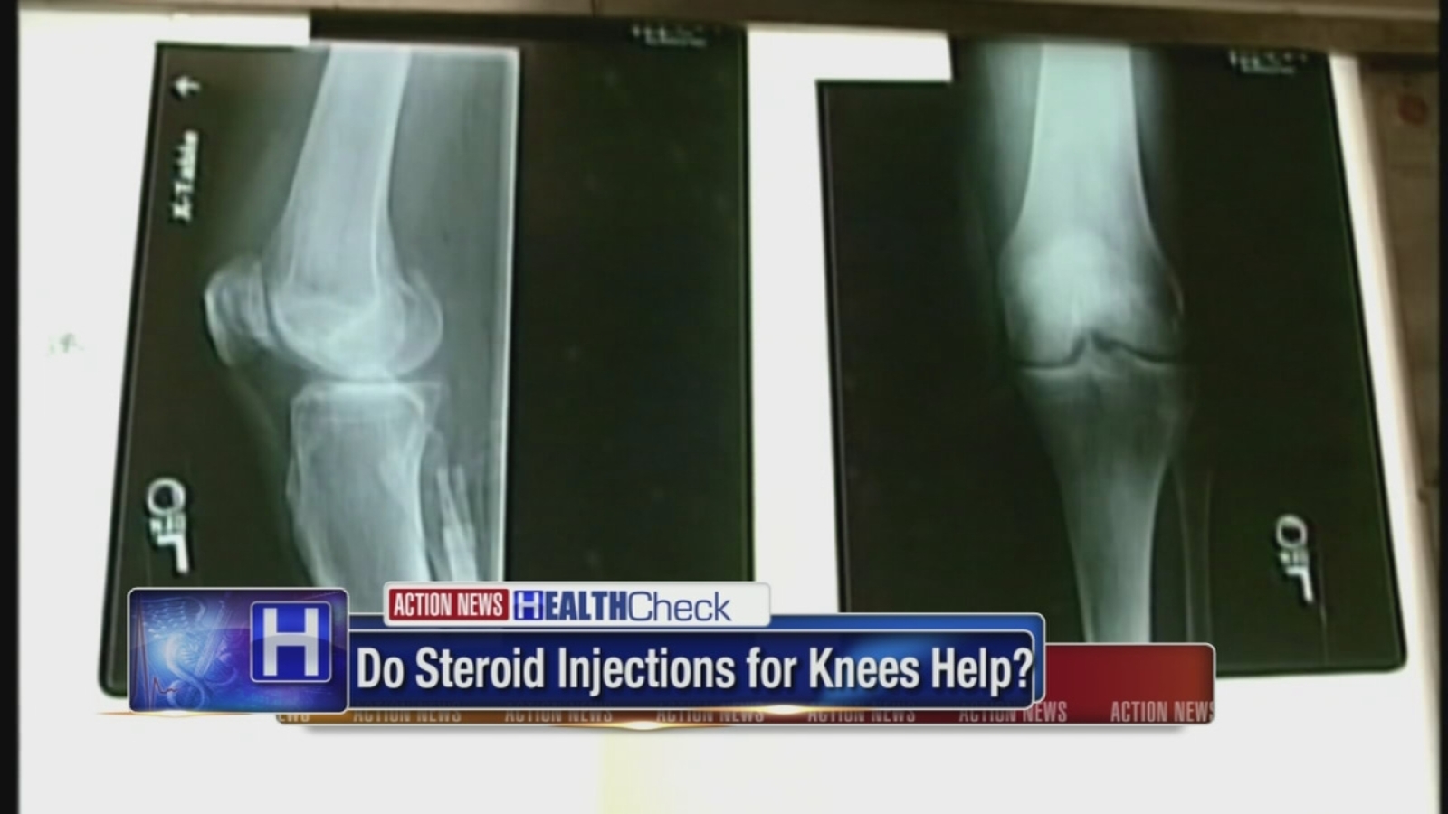 Study: Steroid injections may work as well as placebo - 6abc Philadelphia