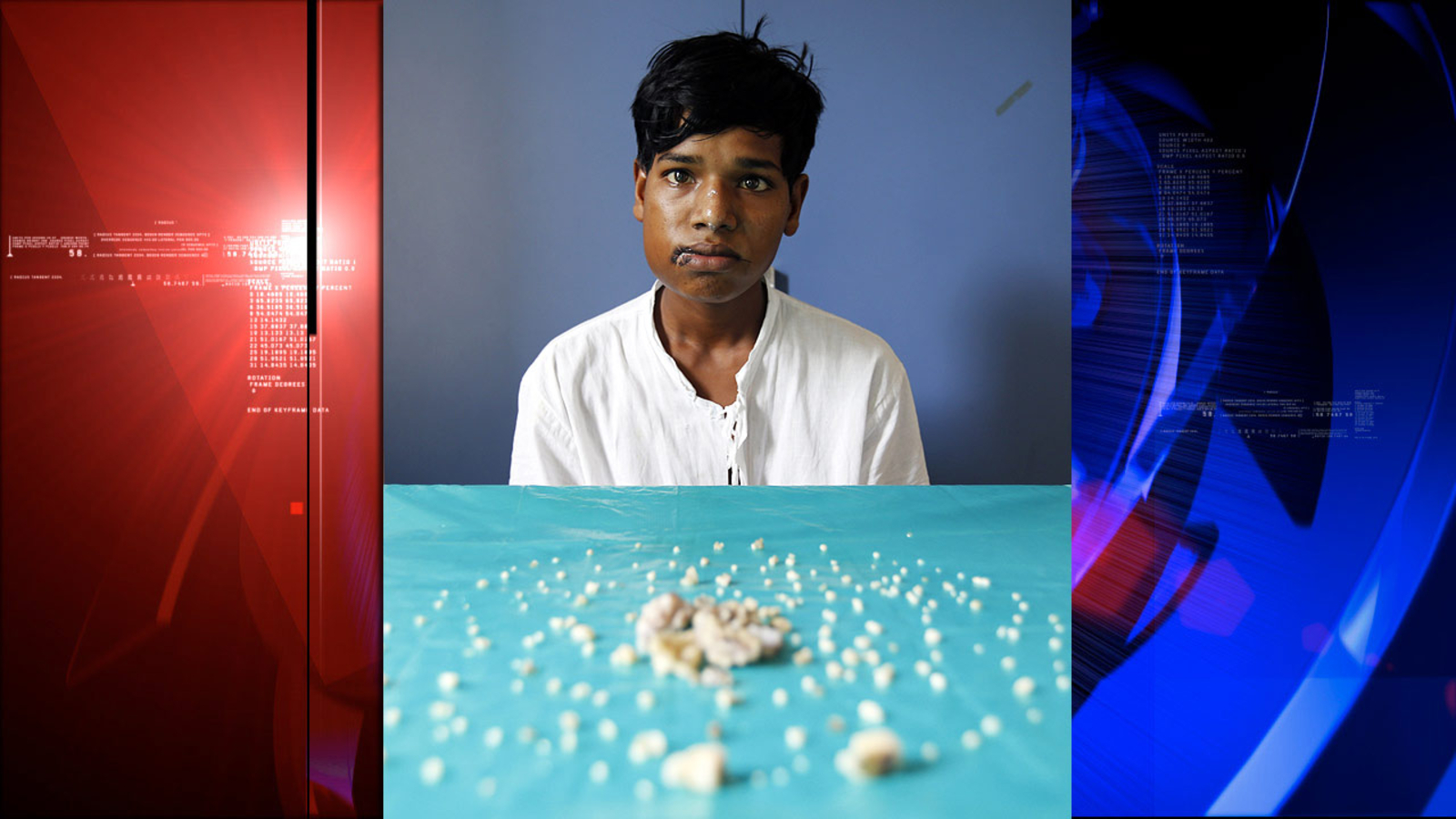Surgeons in India remove 232 teeth from teen - ABC7 New York