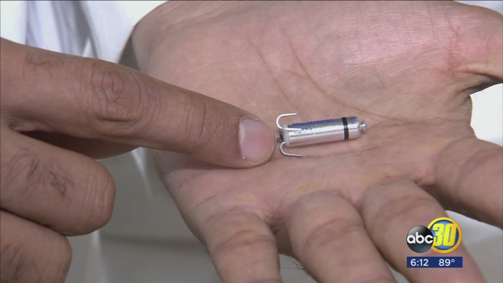 Fresno hospital now offering patients' world's smallest pacemaker ...