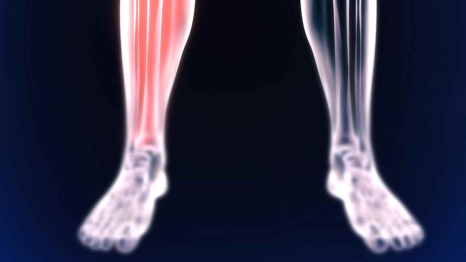 When Leg Pain Cramps Your Style - 6abc Philadelphia