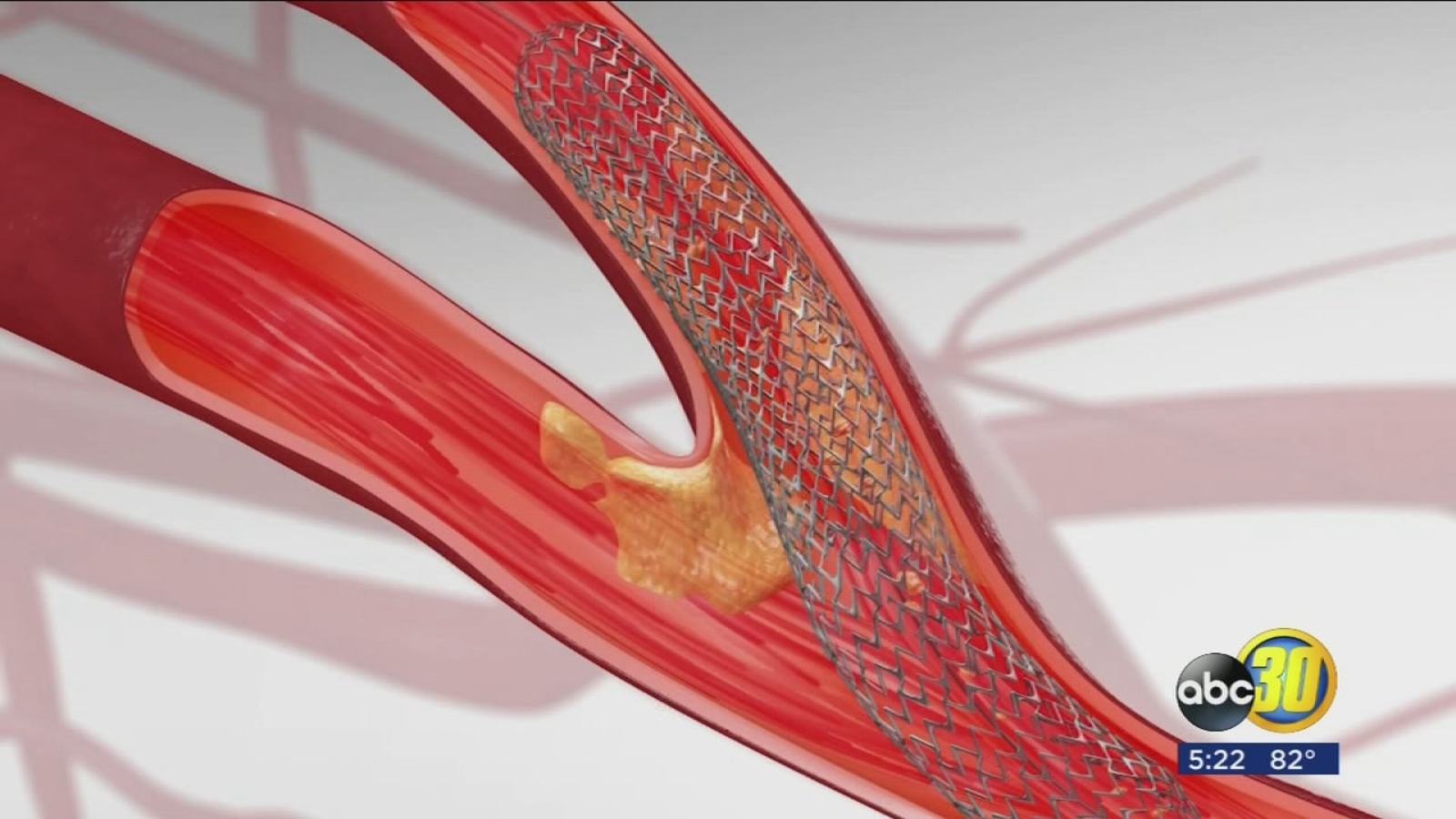 TCAR: Unclogging Carotid Arteries - ABC30 Fresno