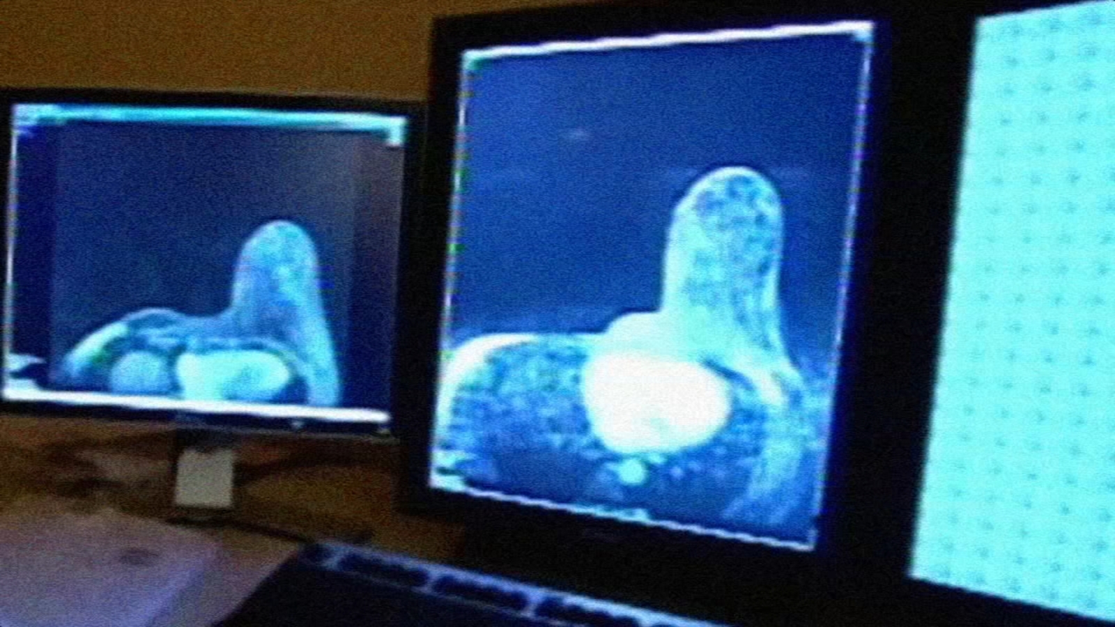 Action News Investigation: Thermal imaging for cancer - 6abc Philadelphia