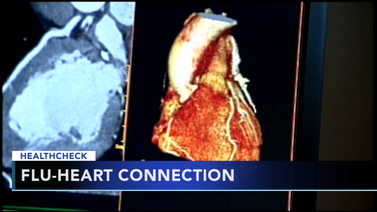 Study links heart attacks among flu patients - 6abc Philadelphia