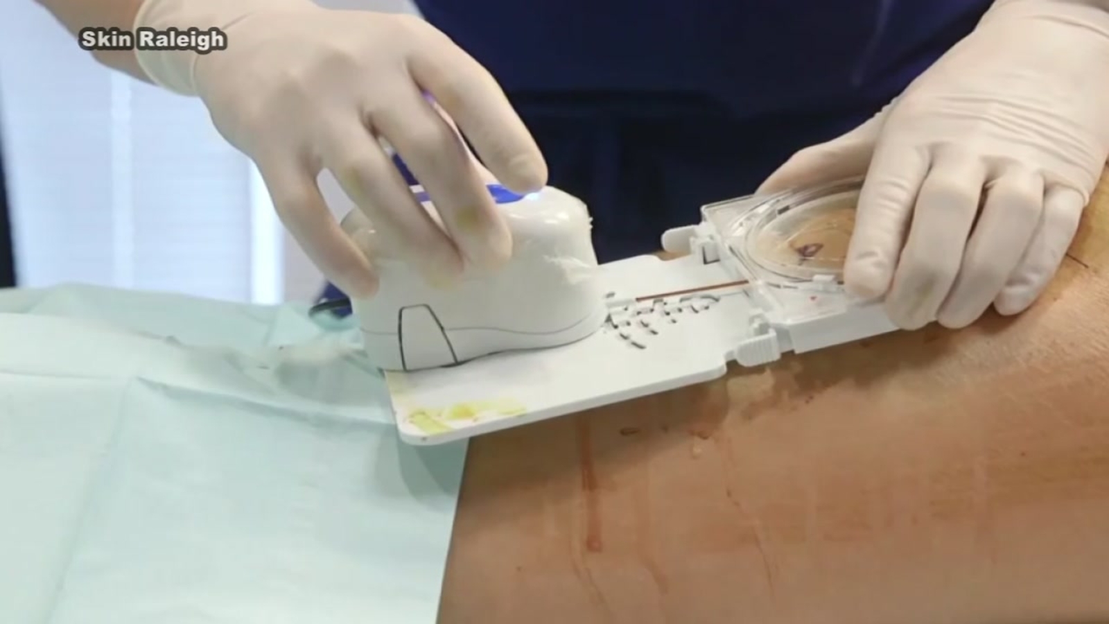 Can a procedure developed in Raleigh get rid of cellulite permanently ...