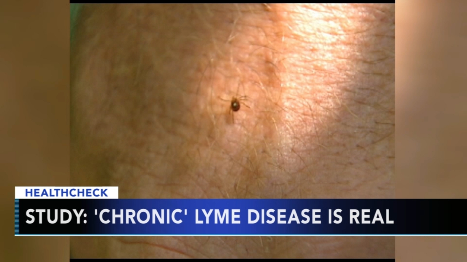 New study reveals long-term effects of chronic Lyme Disease - 6abc ...