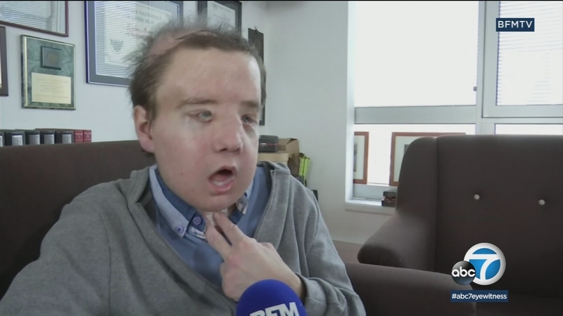 Joshua Face Transplant