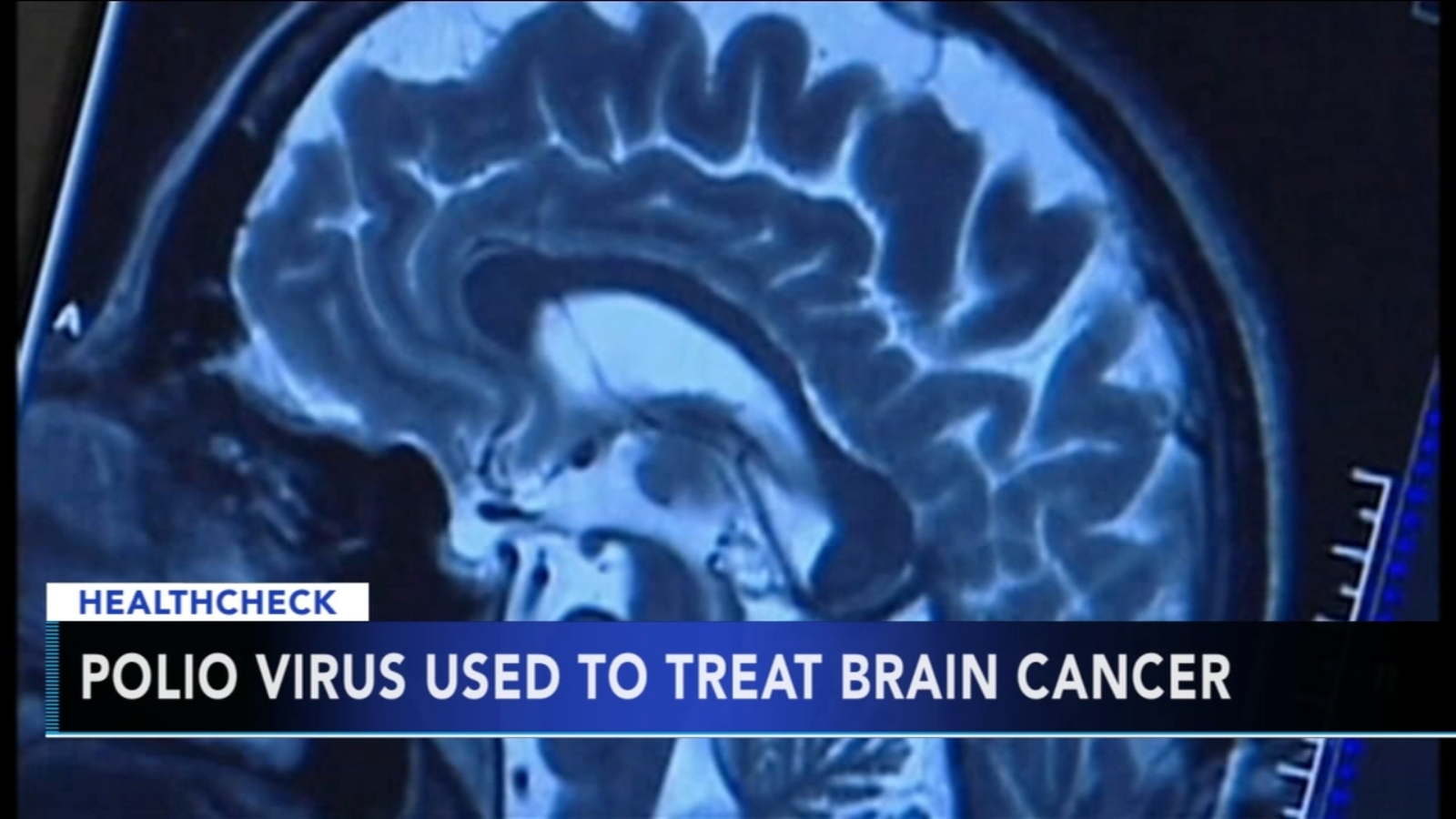 Dreaded poliovirus being used in patients to fight brain tumors - ABC13 ...