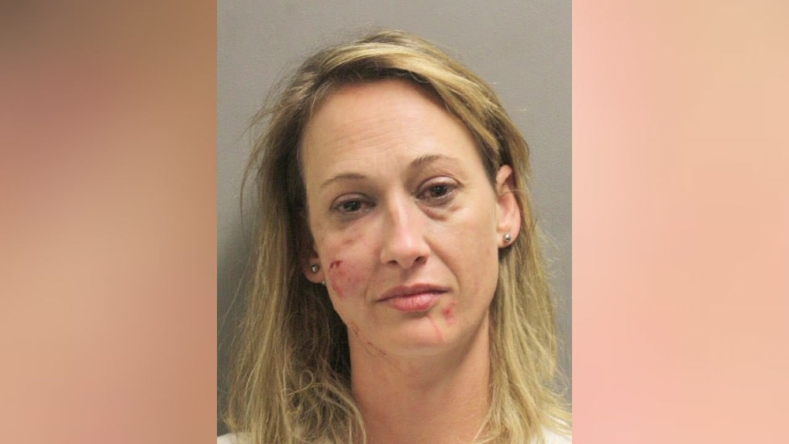 'I don't have a nose': Woman accused of biting off victim's nose and ...