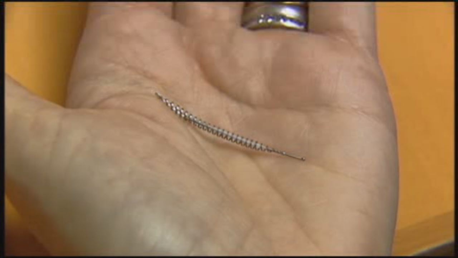 Essure Birth Control