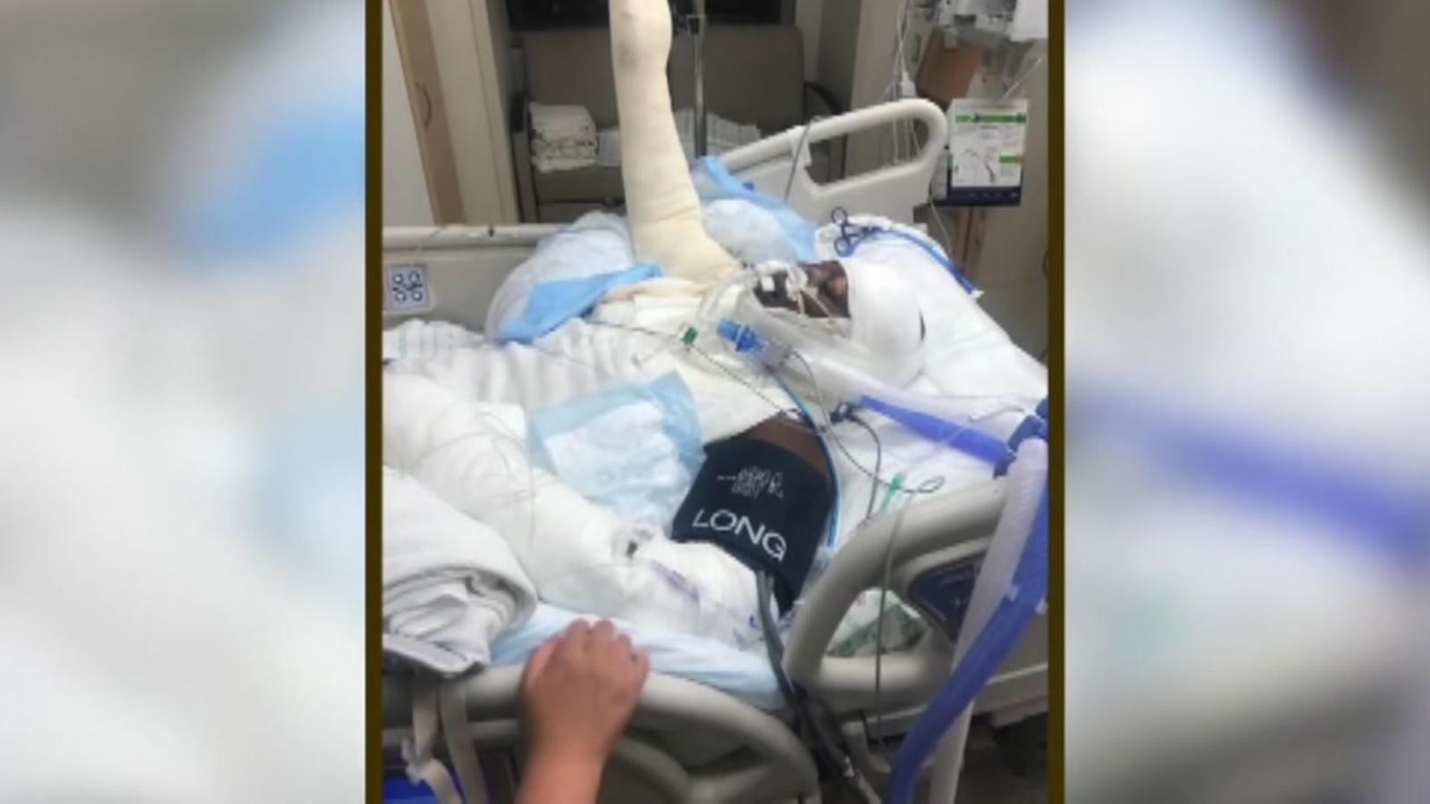 12-year-old girl burned on half of her body after trying viral 'fire ...