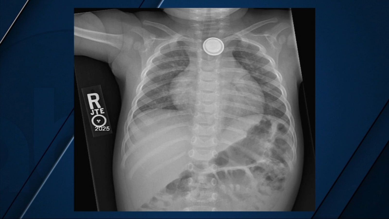 ABC30 Doc Talk: Choking Hazards for Children - ABC30 Fresno